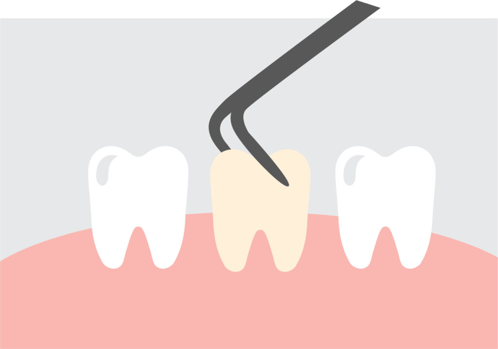 Tooth Extraction - Midwest Dental